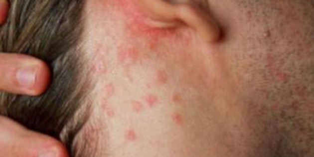 Piel escamosa requiere tratamiento dermatológico | El Informador
