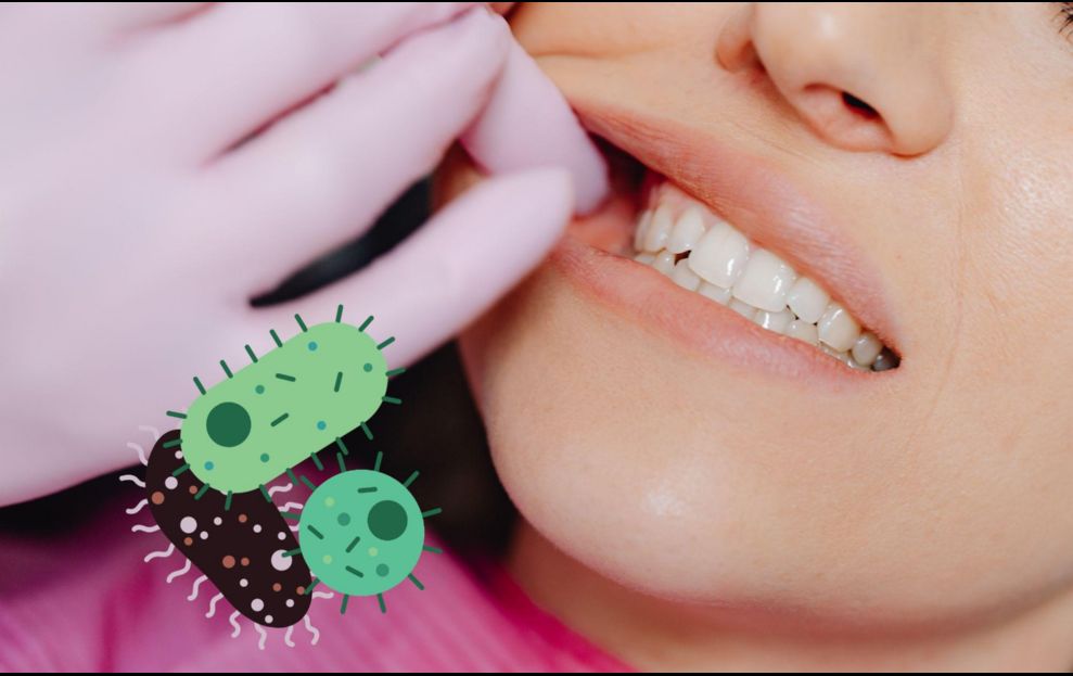 Salud bucal: Estas son 4 enfermedades ligadas con las bacterias de tu ...