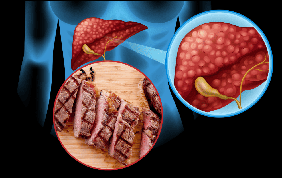 Hígado graso: Estos son los alimentos que NO deberías comer si lo ...
